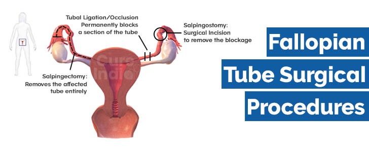 fallopian tubes bilateral