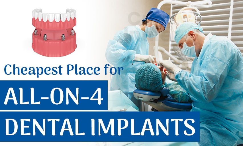 Which is the Cheapest Place to Get All-on-4 Dental Implants?