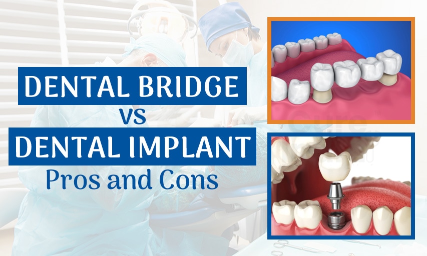 Dental bridge vs. implant: Pros and Cons you want to know
