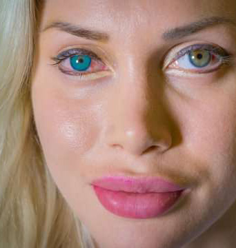 Permanent Eye Color Change Surgery | Iris implant surgery in India