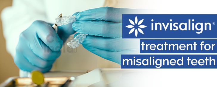 Invisalign Braces in India | Aligners Uses, Procedure,