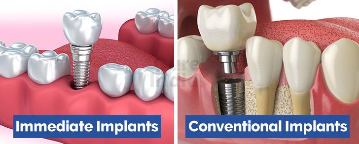 Immediate Loading Implants with warranty in India in best dental clinics
