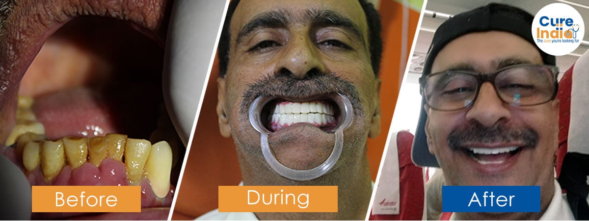 Dental Implants Before and After Pictures of Hundreds of Satisfied Patients