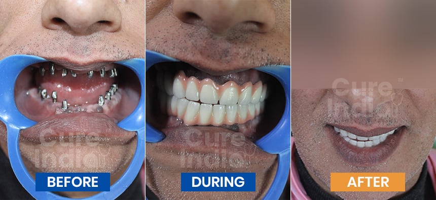 Dental Implants Before and After Pictures of Hundreds of Satisfied Patients