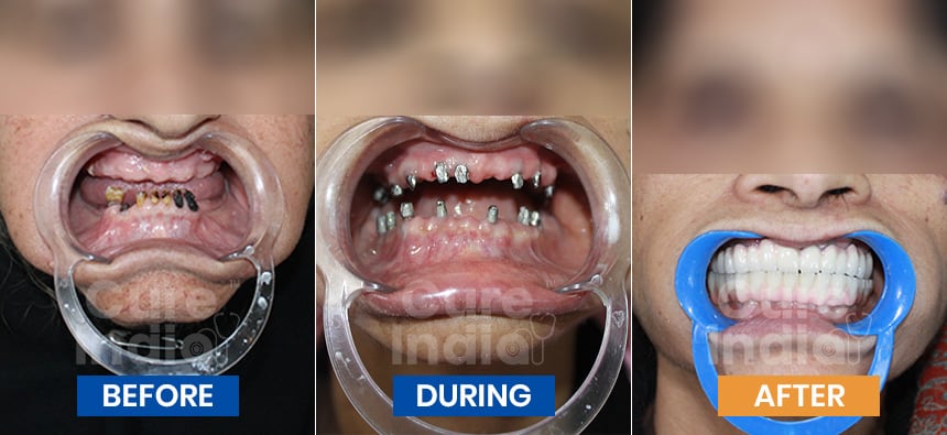 Dental Implants Before and After Pictures of Hundreds of Satisfied Patients