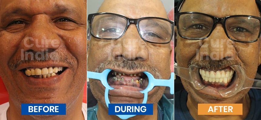 Dental Implants Before and After Pictures of Hundreds of Satisfied Patients