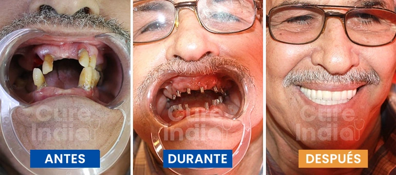 Implantes Dentales de Boca Completa - $10,000 por Ambas Mandíbulas ...
