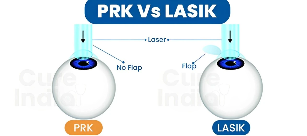 PRK Eye Surgery in India- Top Doctors, Best Hospitals & Costs | CureIndia