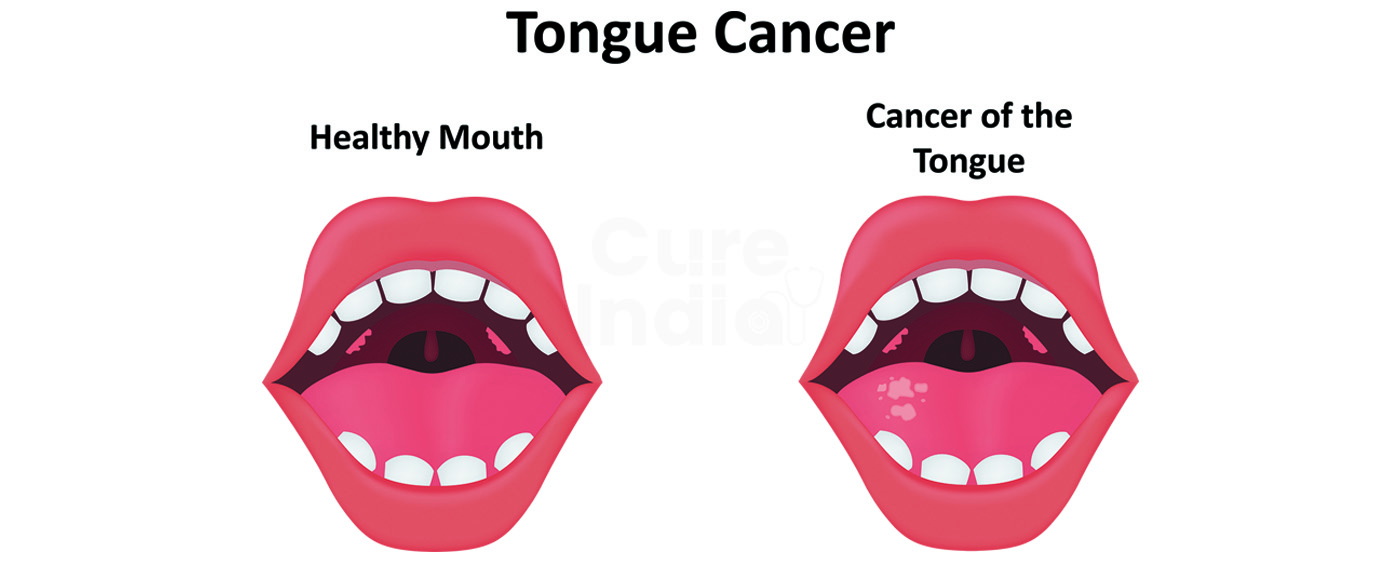 Oral Cancer | Symptoms, Causes and Treatment in India