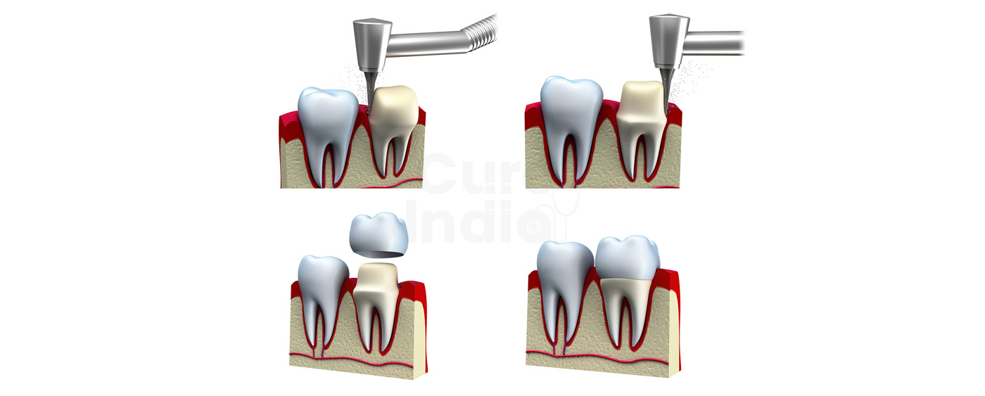 Dental Crowns | Purpose, Procedure, Complications, Care