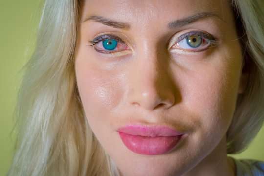 Permanent Eye Color Change Surgery | Iris implant surgery in India